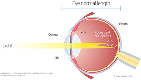 Astigmatism - Anaheim Eye Institute