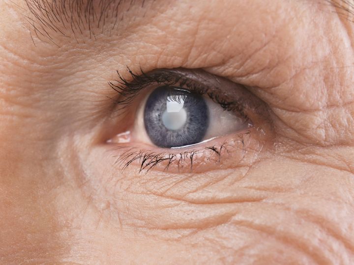 The Three Types Of Cataracts And Their Treatments - Anaheim Eye Institute