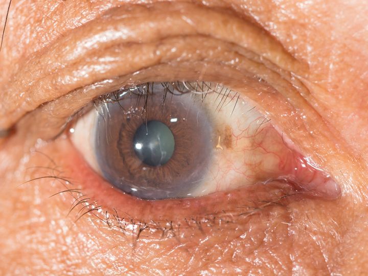 Everything You Need To Know About Trachoma - Anaheim Eye Institute