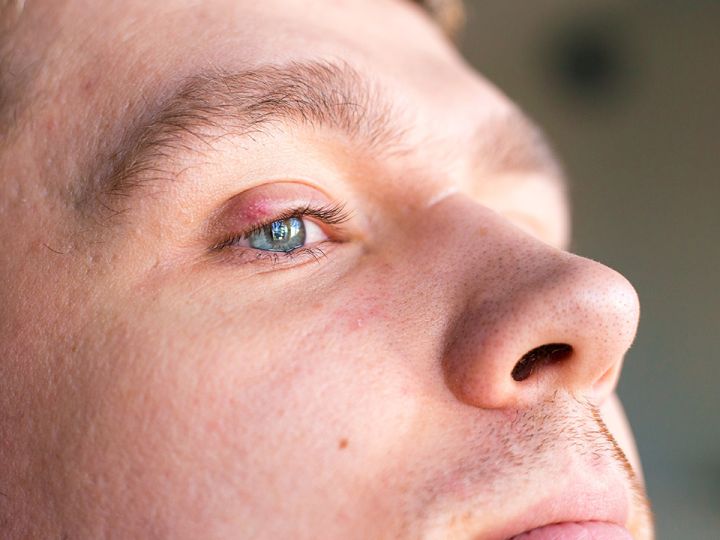 5 Proven Ways of Treating Blepharitis at Home - Anaheim Eye Institute